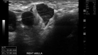 Swollen Lymph Nodes Armpit Ultrasound