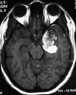 Oiled Brain and Status Epilepticus: Intraventricular and Subarachnoid ...
