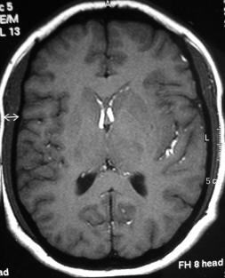 Oiled Brain and Status Epilepticus: Intraventricular and Subarachnoid ...