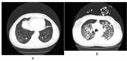 Cryptococcus Pneumonia Complicating Churg-Strauss Syndrome | Al Mohajer ...