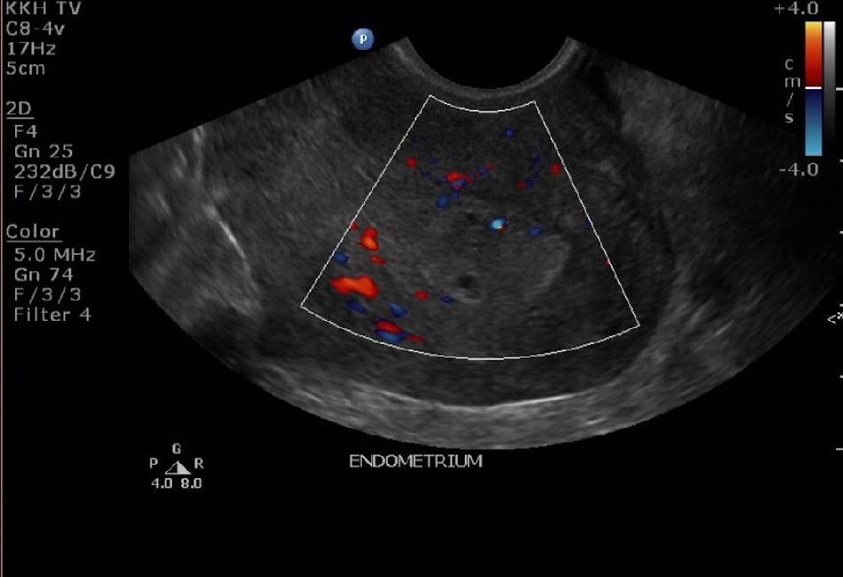 Endometrial Hyperplasia Ultrasound Appearance
